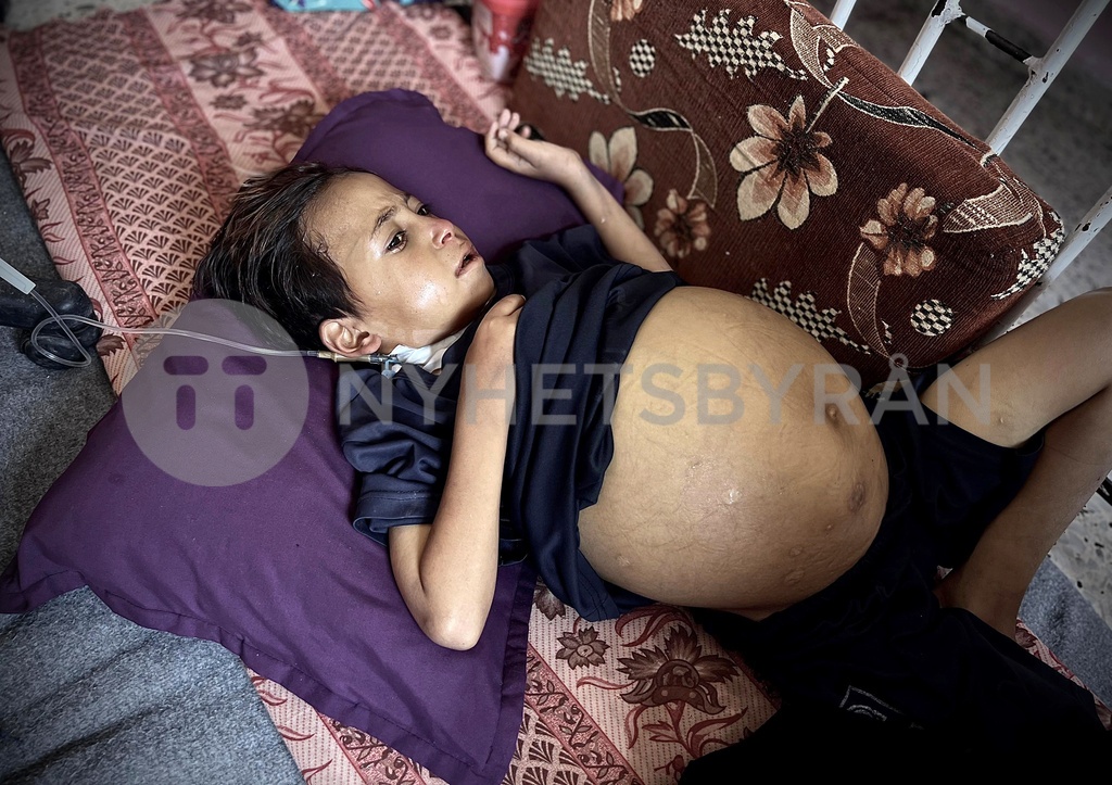 Gaza child with enlarged spleen and liver struggles to survive